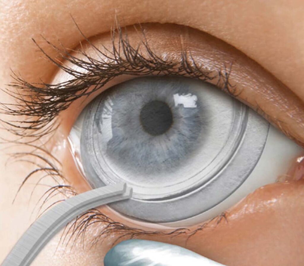 Dry Eyes Austin | PROKERA® Austin | Westlake Eye