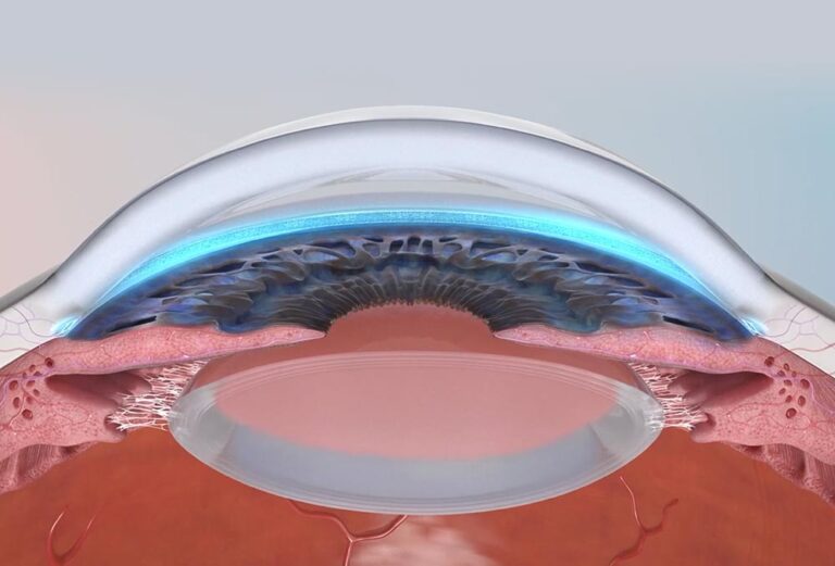 Glaucoma Austin | Glaucoma Treatment Austin | Westlake Eye
