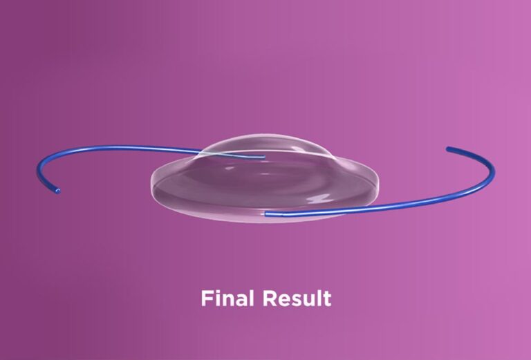 Light Adjustable Lens | Westlake Eye Specialists