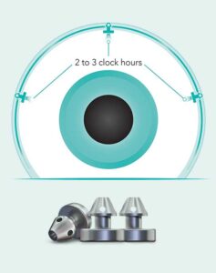 Glaukos iStent Infinite | MIGS Glaucoma Surgery | Austin Glaucoma ...