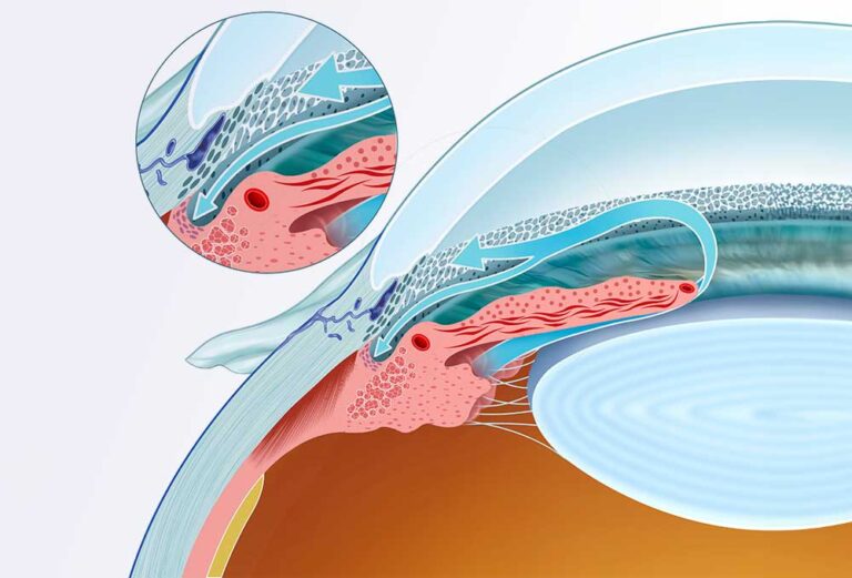 Glaucoma Stent Surgery | iStent, Hydrus, iStent Infinite | Austin ...